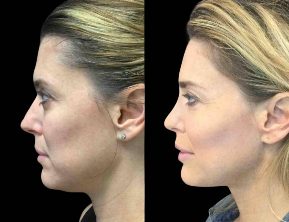 Real Patient Case: 35051 | Bitar Cosmetic Surgery Institute | Fairfax, VA