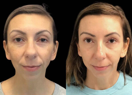 Eyelid Lift (Upper) Before and After Photos | in Fairfax, VA | Bitar ...